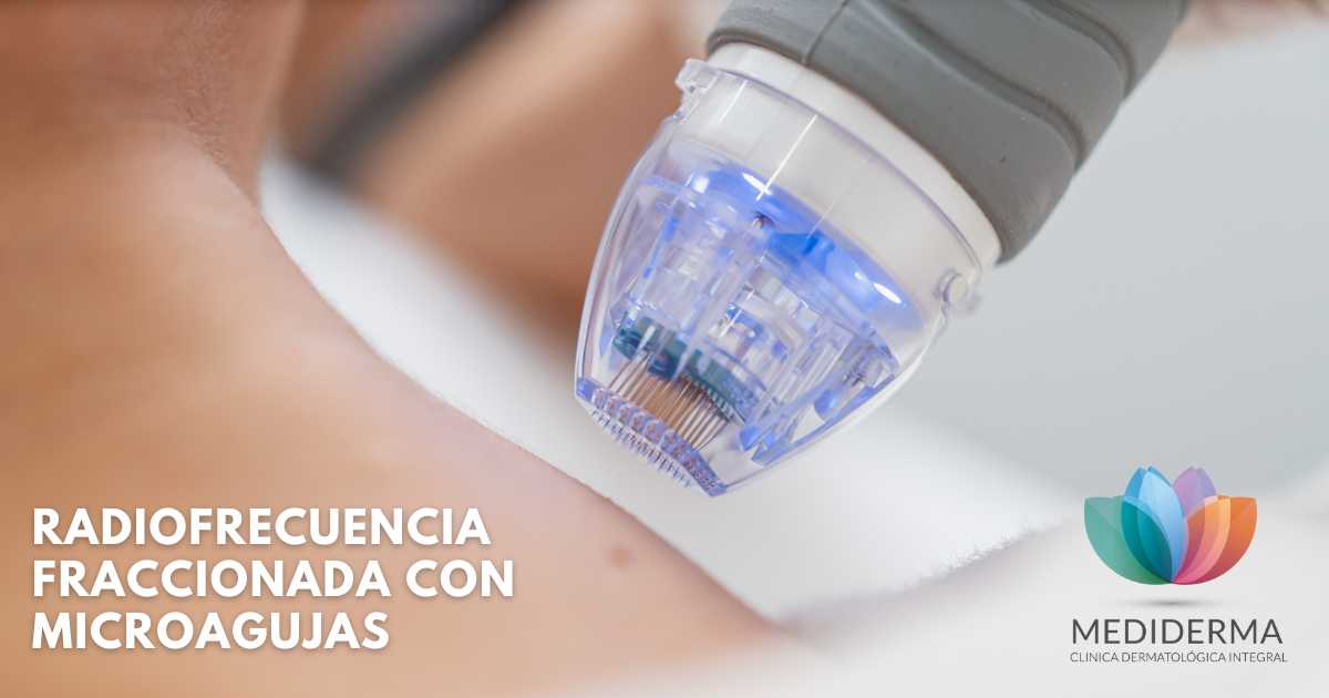 Radiofrecuencia Fraccionada con Microagujas - Clínica Mediderma