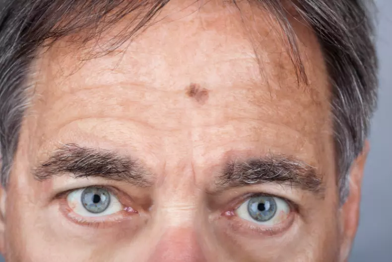 Lentigo Solar - Clínica Mediderma